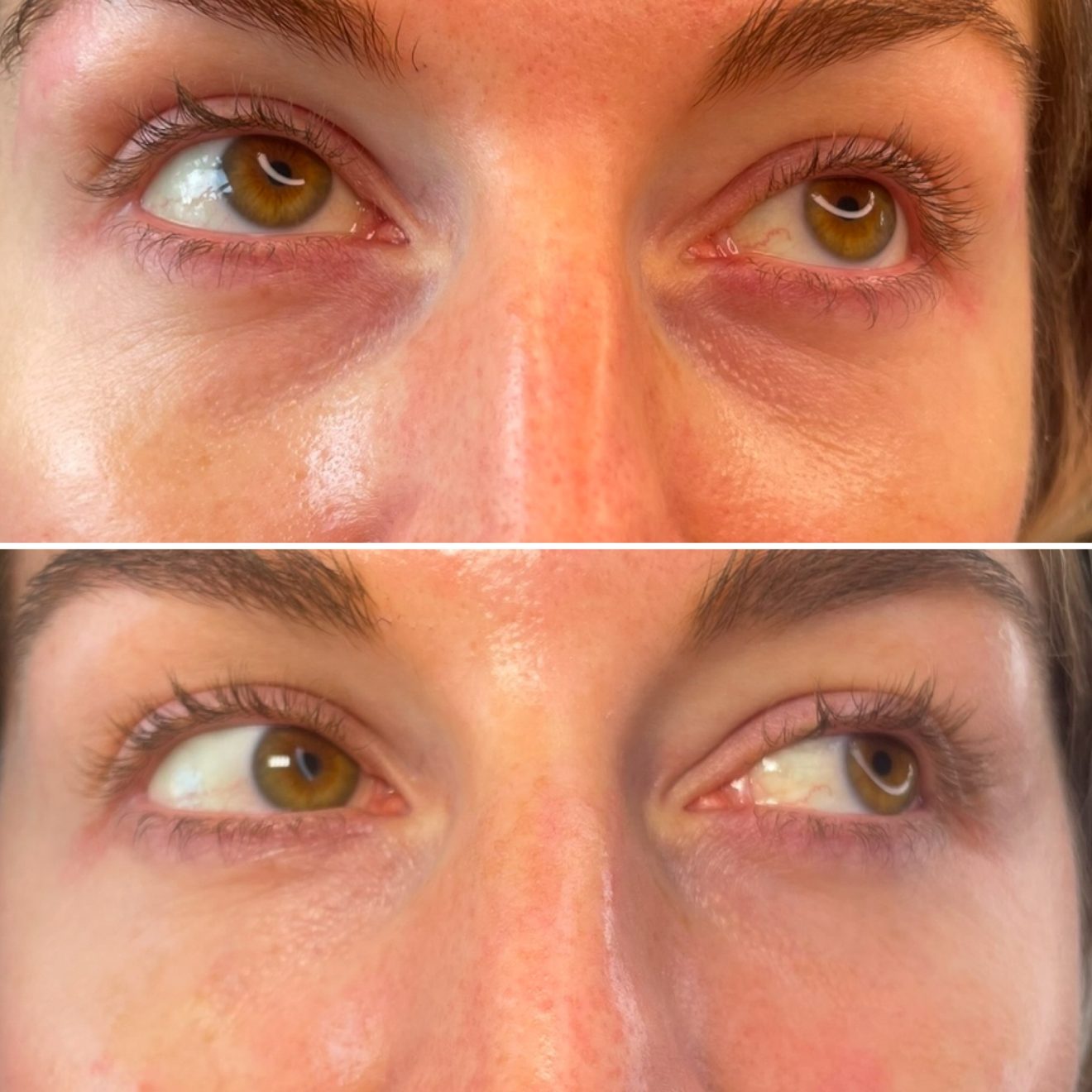 Polynucleotides Liverpool | Polynucleotides Injections